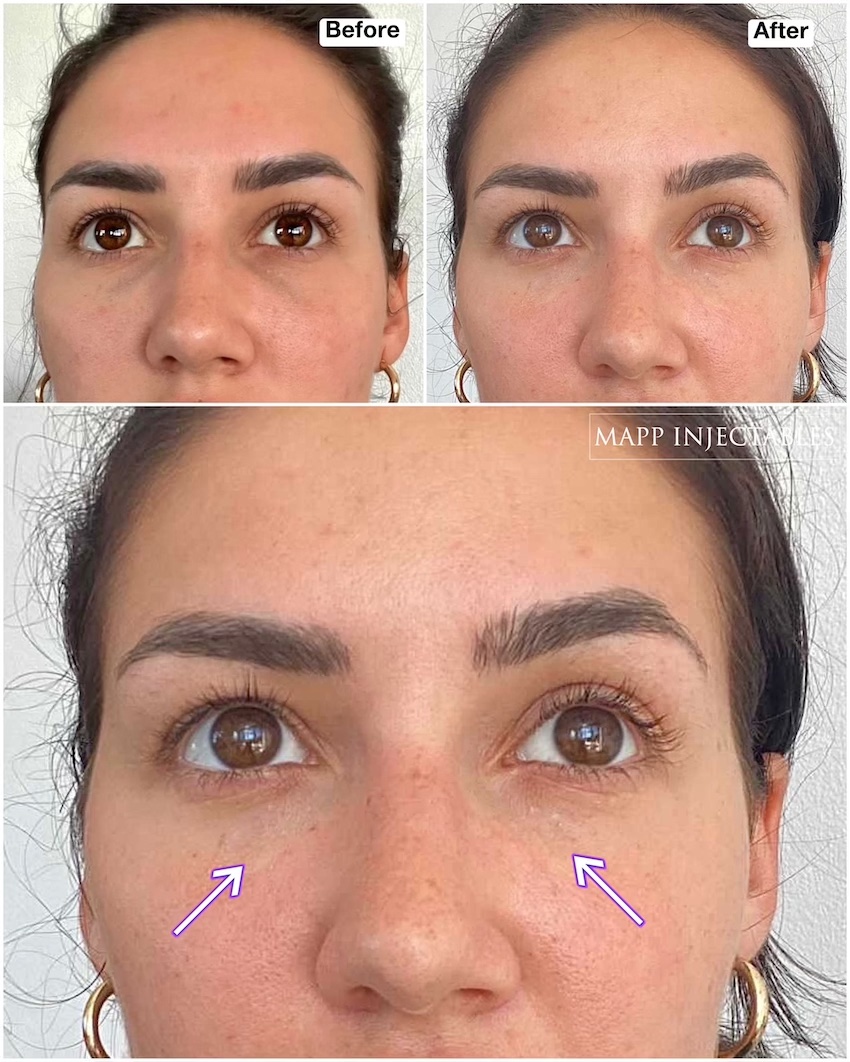 Tyndall Effect Juvederm